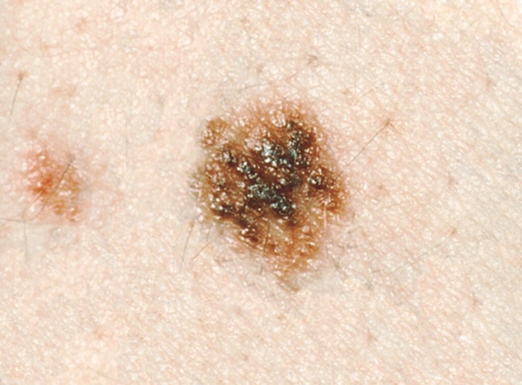 What Does Precancerous or Atypical Mole Mean? » Scary Symptoms