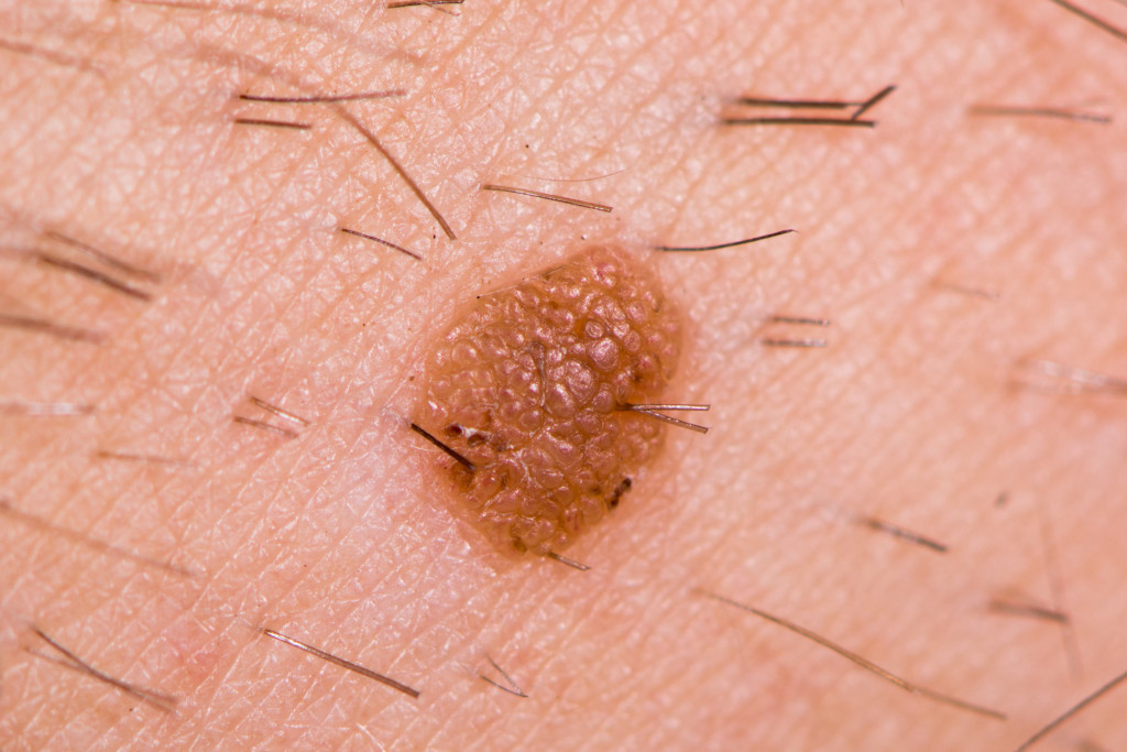 Half of Mole Suddenly Falls Off, Bleeds » Scary Symptoms