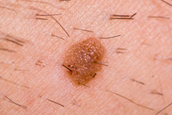 Is a Fast Growing New Mole Always a Melanoma ? » Scary Symptoms