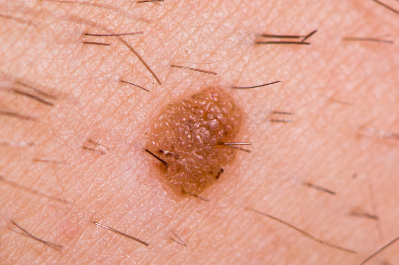Half of Mole Suddenly Falls Off, Bleeds » Scary Symptoms