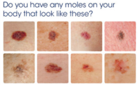 Fading Moles: Melanoma, or Could this Be Something Else Besides Skin ...