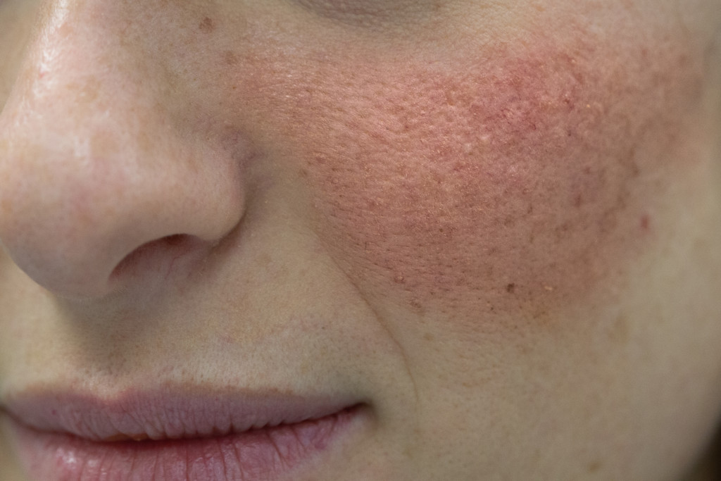 Rough Red Patch On Nose Or Cheek What This Might Be Scary Symptoms