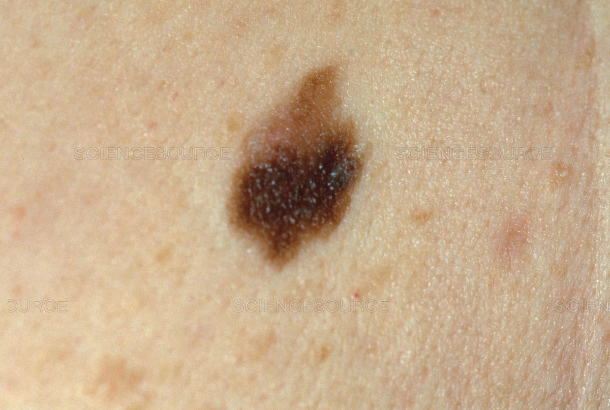 Are New Moles in Older Age Really Dangerous or Is Data Lacking? » Scary ...