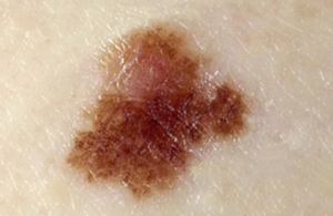 What Does Precancerous or Atypical Mole Mean? » Scary Symptoms