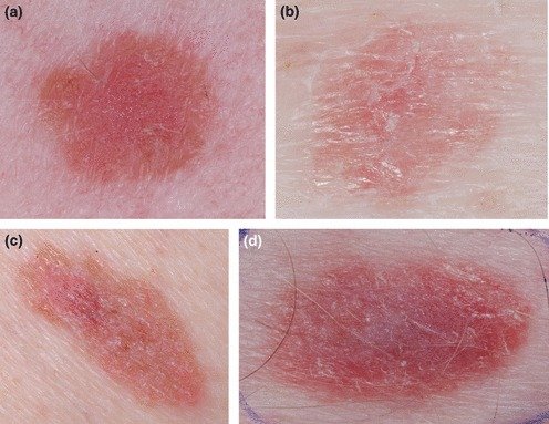 Red Dots on Skin: 19 Causes, Some Serious » Scary Symptoms