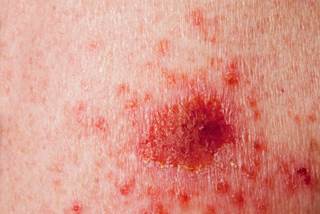 What Those Tiny Red Dots on Your Skin Might Mean » Scary Symptoms