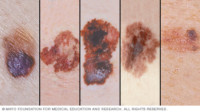 Asymmetric Moles and Melanoma: Detailed Guidelines » Scary Symptoms