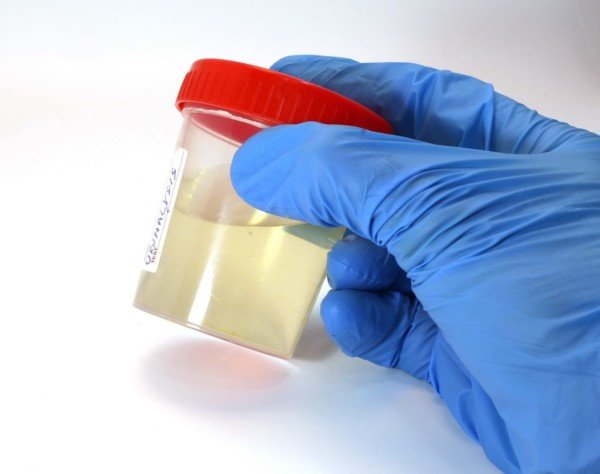 Causes of Cloudy Urine, How to Examine, Cancer » Scary Symptoms