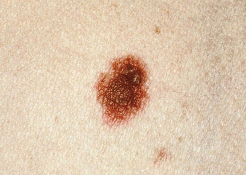 Are Most Funny Looking Moles Normal & Benign? » Scary Symptoms