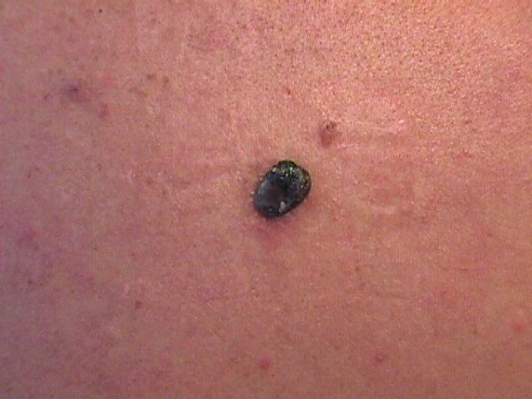 When an Itching Mole Begins Bothering You » Scary Symptoms