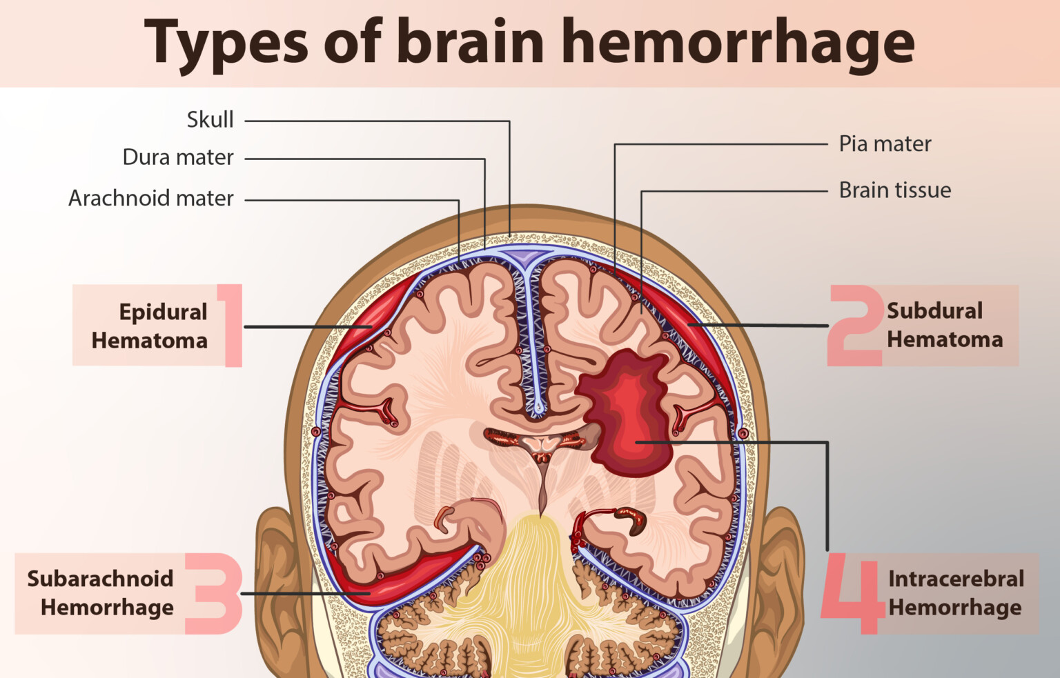 BRAIN BLEED from Concussion Can Mean Subdural Hematoma » Scary Symptoms