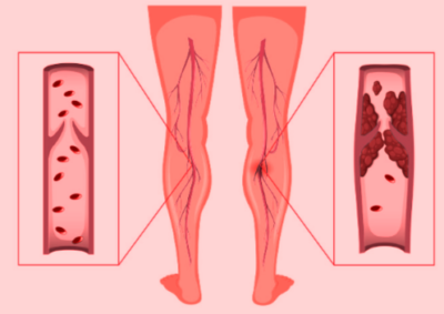 How Does Surgery Cause a DVT? » Scary Symptoms