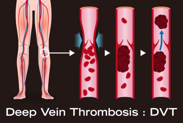 Can You Ride a Bike with a DVT in Your Leg? » Scary Symptoms