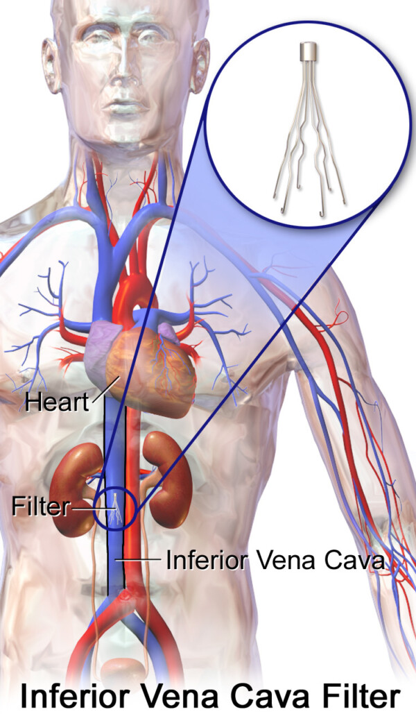 Post-Surgical DVT Treatment without a Blood Thinner? » Scary Symptoms