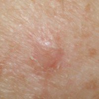 How to Spot a Melanoma that’s Flesh or Pink Colored » Scary Symptoms