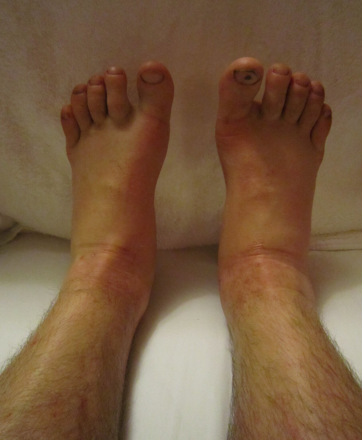 Benign Causes Of Both Ankles Being Swollen Puffy And Treatment