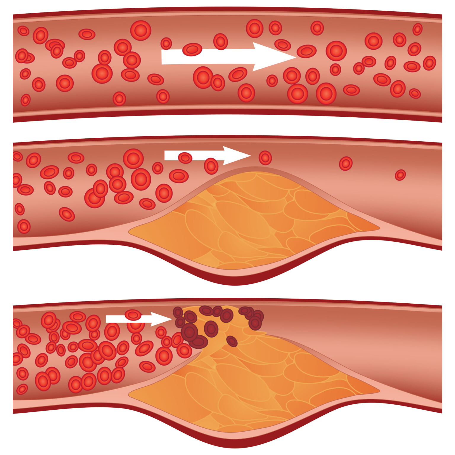 High Calcium Score but Normal Stress Test: Should You Worry? » Scary ...