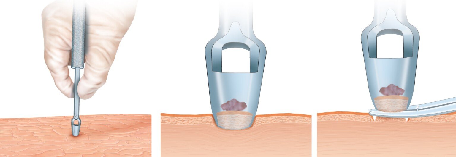 Punch Biopsy For A Mildly Atypical Mole Scary Symptoms