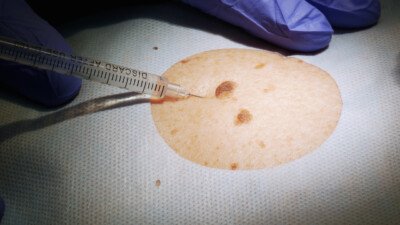 How Painful Is Surgical Mole Removal? » Scary Symptoms