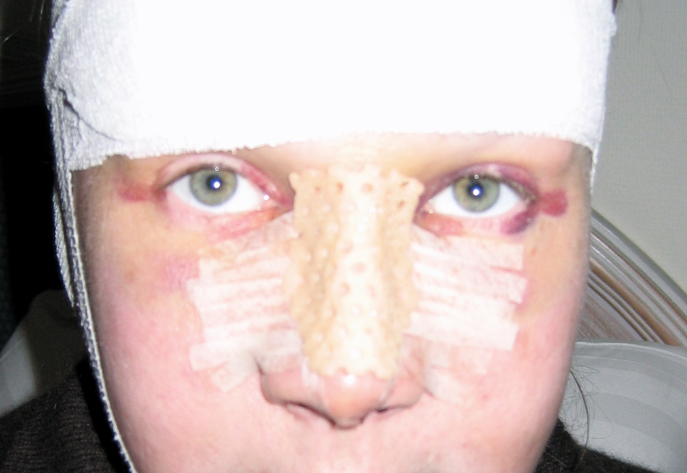 Rhinoplasty: How Painful Is a Nose Job; First Person Account » Scary ...