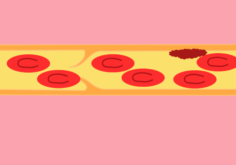 Hip Pain Three Months after Hip Replacement: Causes, Solutions » Scary ...