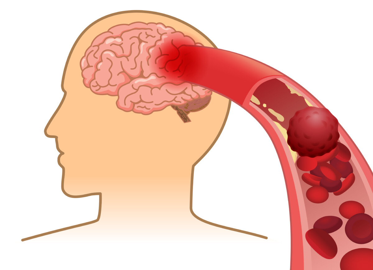 Can A TIA Cause A Metal Taste In The Mouth Scary Symptoms Can A TIA Cause A Metal Taste In The Mouth Scary Symptoms