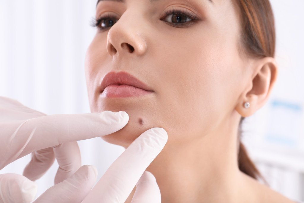 What Does Pus Coming out of a Mole Mean? » Scary Symptoms