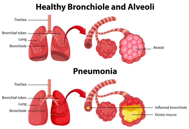 Can Pneumonia in the Elderly Be Only Mild ? » Scary Symptoms