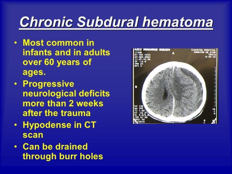 Most Common Symptoms of Chronic Subdural Hematoma in Elderly » Scary ...