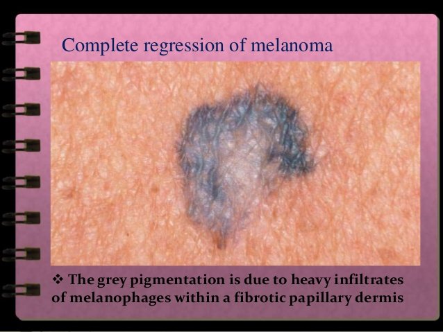 How Common Are Grey Moles? » Scary Symptoms