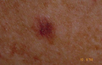 How Common Are Red Moles? » Scary Symptoms