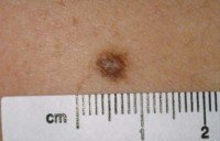 How Common Are Grey Moles? » Scary Symptoms