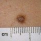 How Common Is Melanoma Black; Can a Normal Mole Be Black? » Scary Symptoms