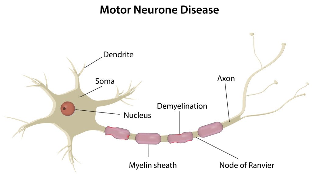 Early ALS Muscle Atrophy vs. Benign Atrophy Appearance » Scary Symptoms