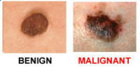 Moles & Melanoma Guide to Changes, Colors, Size & More » Scary Symptoms
