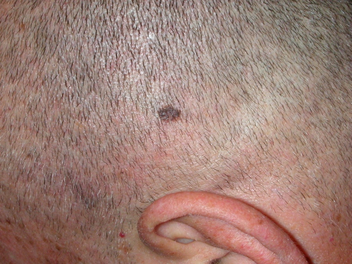 Skin Cancer On Scalp Prevention Tips For Bald Men Scary Symptoms