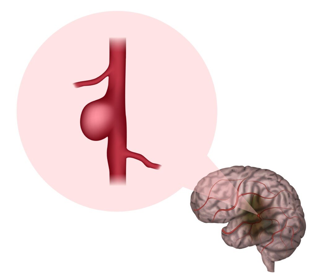 Aneurysm Headache Vs Normal Headache Recognizing The Difference Scary Symptoms