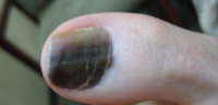 Black Area on Big Toenail: Melanoma or ?? » Scary Symptoms