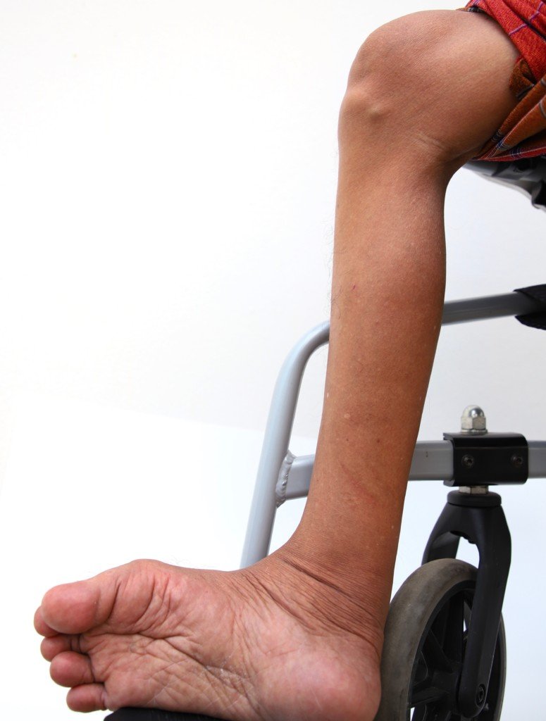 Benign Calf Dent or Muscle Atrophy: Your Last Article! » Scary Symptoms