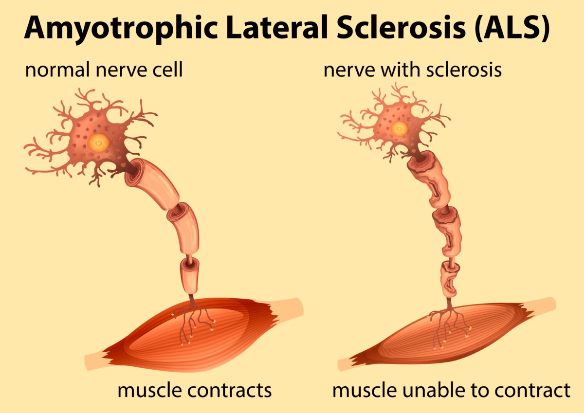 Strength Tests if You Fear ALS for Legs & Upper Body » Scary Symptoms