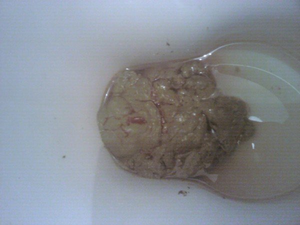 Doctor Describes what Clay Colored Stools Look Like » Scary Symptoms