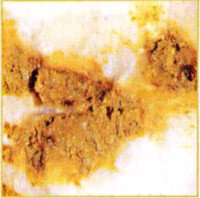 Can Gallbladder Problem Cause Loose Orange Stools? » Scary Symptoms