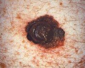 What Colors Can Melanoma Skin Cancer Be? » Scary Symptoms