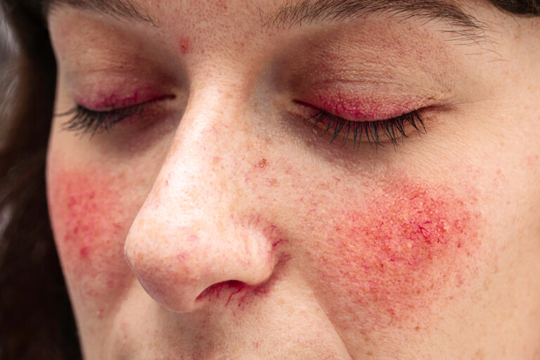 Persistent Red Rash on Cheeks: Doctor Explains » Scary Symptoms
