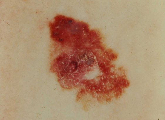 Malignant Melanoma vs. Benign: The Difference » Scary Symptoms