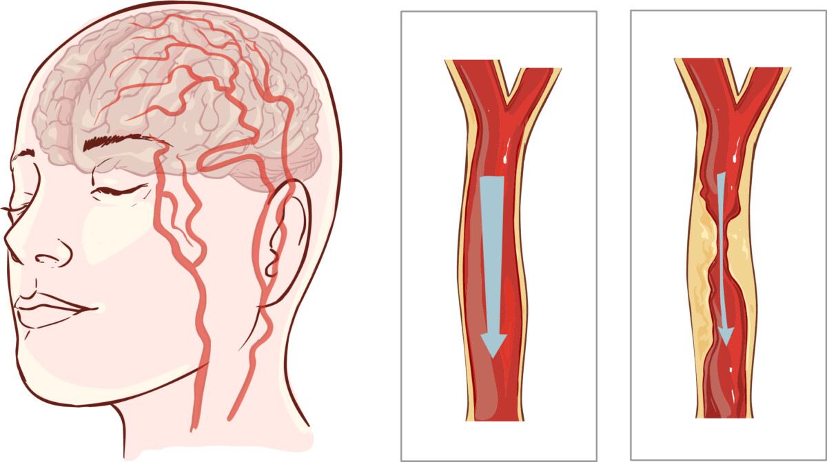 TRANSIENT ISCHEMIC ATTACK: Symptoms, Duration, Answers » Scary Symptoms