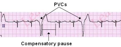 Does Having PVC’s when Relaxed Mean a Serious Heart Problem? » Scary ...