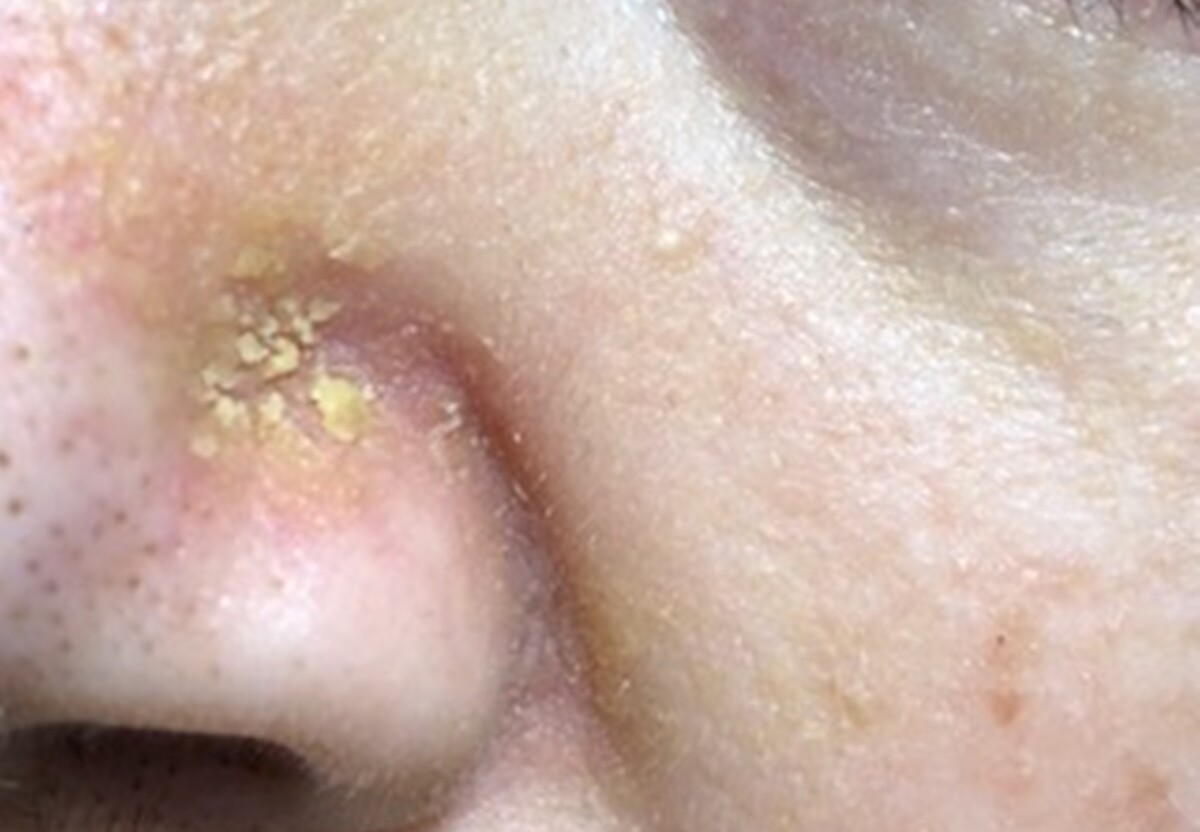 What’s this Crusty Stuff in My Ear that Keeps Recurring? » Scary Symptoms