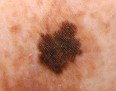 Mole vs. Lentigo: Dermatologist Sets the Difference Straight » Scary ...