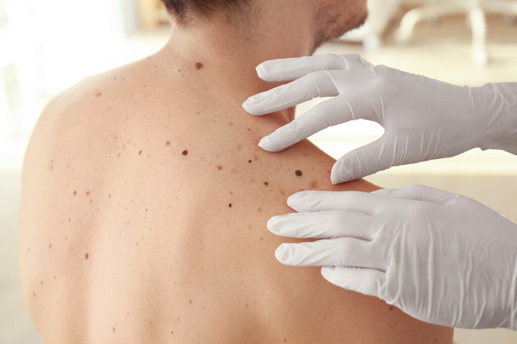 Does Melanoma Make You Get More Normal Moles Every Year? » Scary Symptoms